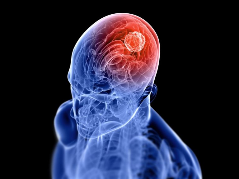 6 Brain Tumor Warning Signs You Should Know - Mather Hospital