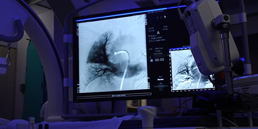 What is thrombectomy? - Mather Hospital